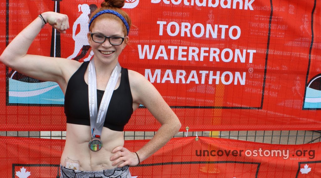 I’m Only Half Crazy! - Uncover Ostomy